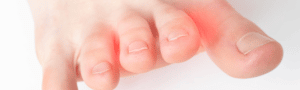 Polyarthrite Rhumatoïde : Symptômes, Causes & Traitements
